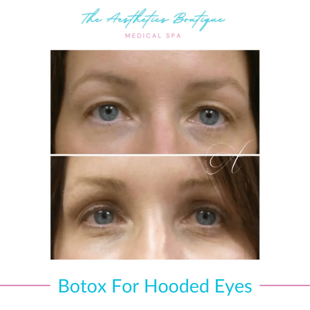 Botox Dysport, Xeomin in Binbrook and Hamilton | Botox Smile Line